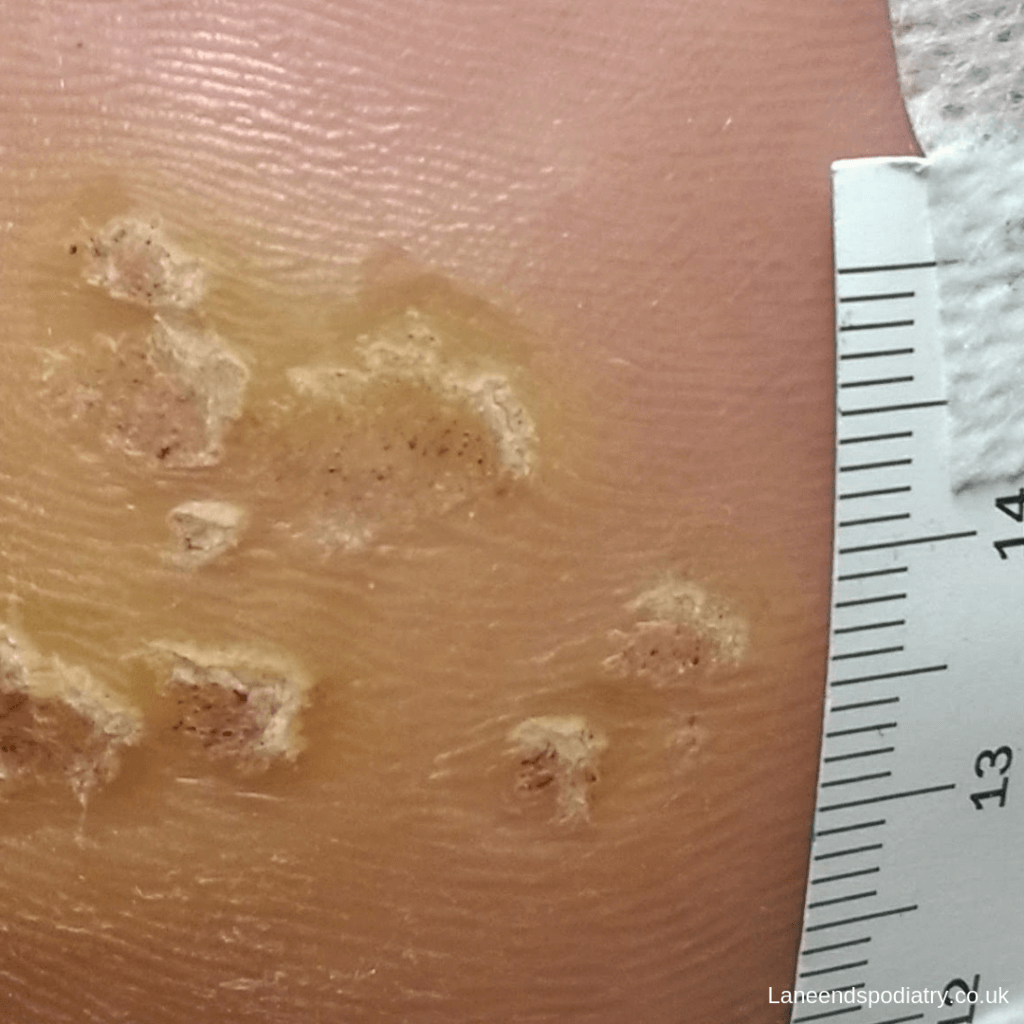 How Long Does Verruca Virus Live Outside The Body at Hudson Becher blog