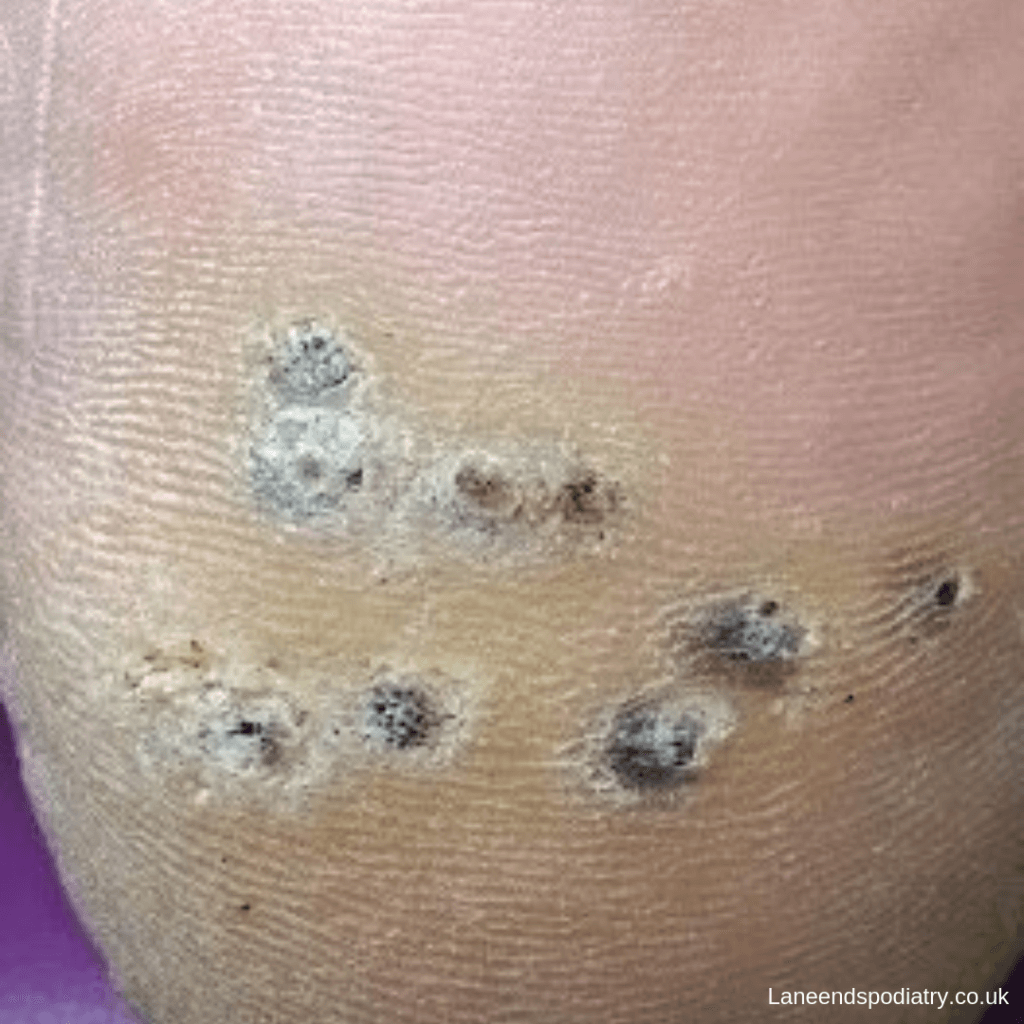 Verruca: What is it? – Potty Purple Pod