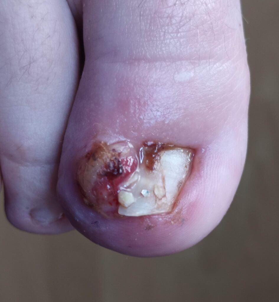 Antibiotics for infected toe store