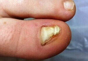 Potty Purple Pod – Warrington Podiatry – Dianne Ashcroft